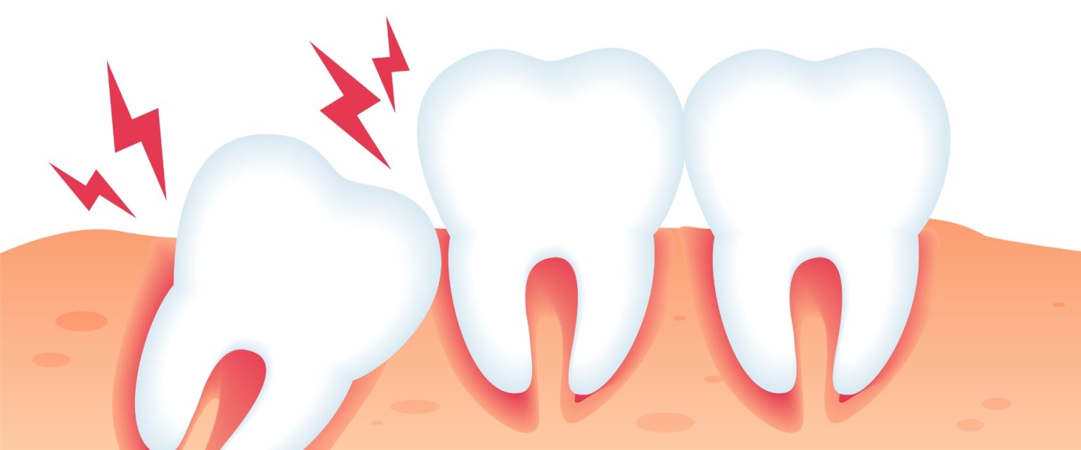 Masele de minte | Cand este necesara extractia | Life Dental Spa